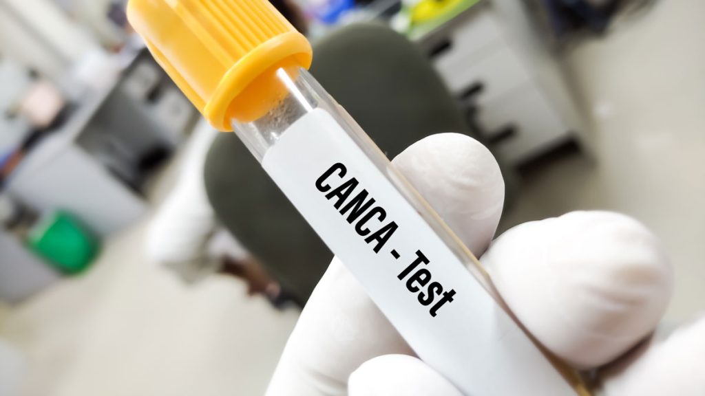 C-ANCA (PR3-ANCA) Testi Nedir? | Ne İşe Yarar, Ne Zaman Yapılır?