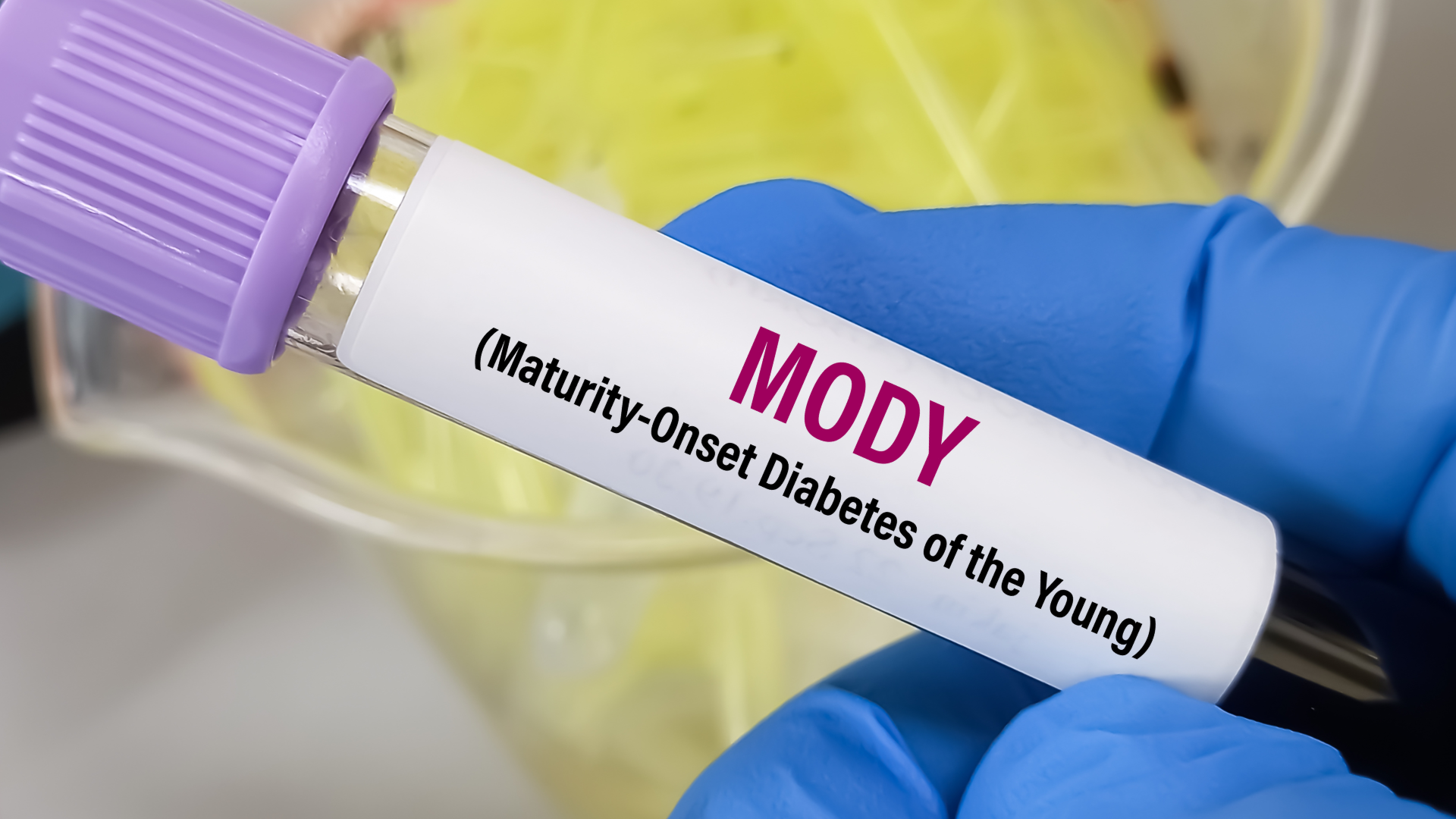 MODY Paneli Fiyatı | Monojenik Diyabet İçin Genetik Tanı Testi