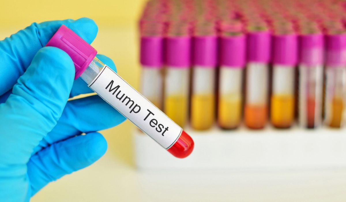 Mumps (Kabakulak) IgM Testi Fiyatı | Aktif Enfeksiyon Tanısı